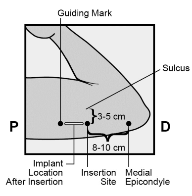 Nexplanon insertions in Fort McMurray – Walk-In Clinic Fort McMurray